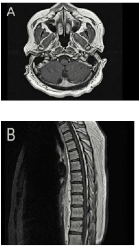 Isolated Neurosarcoidosis Mimicking Multiple Sclerosis Neurosciences