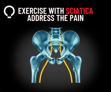 Exercising With Sciatica Addressing The Pain Functional Patterns