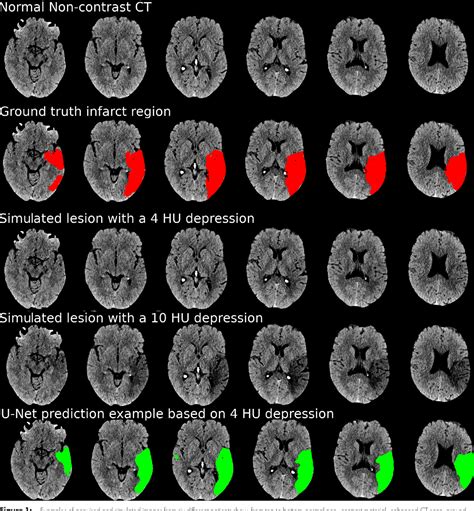 Figure 1 From Optimizing Deep Learning Algorithms For Segmentation Of Acute Infarcts On Non