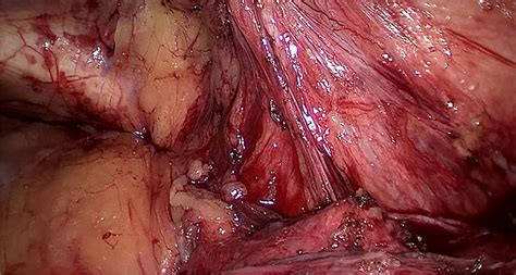 Intraoperative Laparoscopic View Of The Preperitoneal Space Download Scientific Diagram