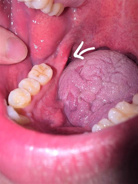 발치했는데 잇몸옆에 딱딱한게 만져집니다 지식in