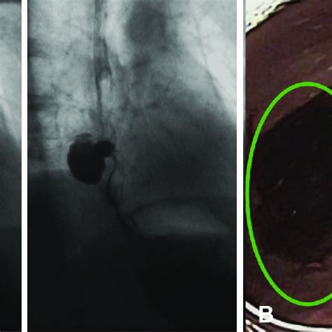 Endoflip Topography Of Case 1 At A Volume Of 60 Ml A Pre Poem Download Scientific Diagram