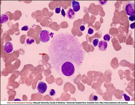 Myelodysplastic Syndrome With Isolated Del5q Cell Atlas Of