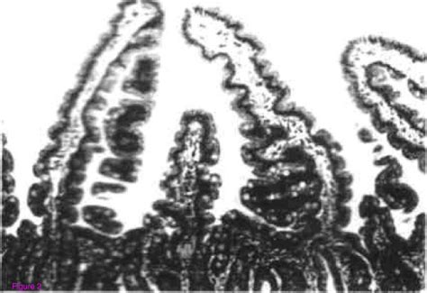 Total Villous Atrophy With Crypt Hyperplasia Of The Second Portion Of