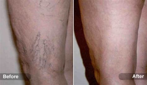 Spider Vein Treatment At Laser Vein Center St Louis Varicose Vein Treatment