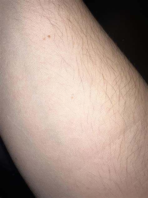 Red Spots On Arm Petechiae Or Tiny Cherry Angiomas Rdermatology