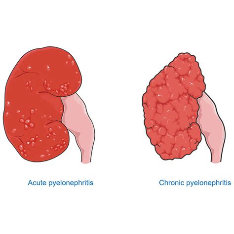 Pyelonephritis Vector