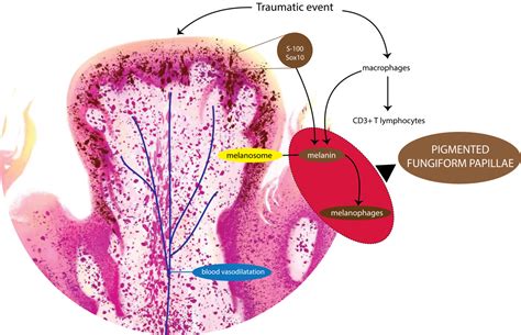 Figure 1 From Pigmented Funorm Papillae Pfp Of The Tongue A