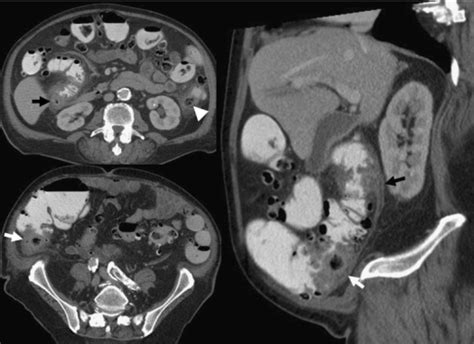 Synchronous Multifocal Diverticulitis With Three Inf Open I