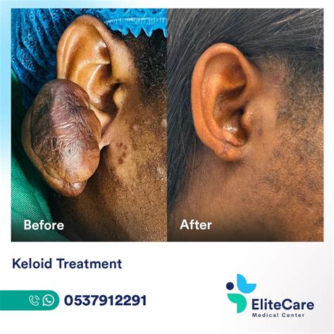 Keloids Treatment In Accra Ghana Elitecare Center