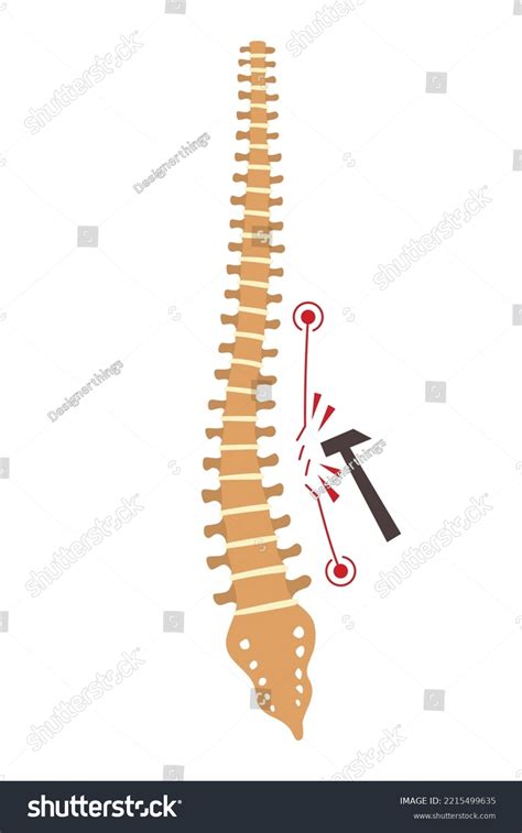 Spinal Deformity Symbol Spine Curvatures Unhealthy Stock Vector Royalty Free 2215499635