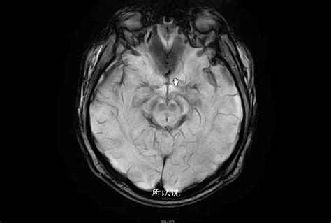 头颅mri Mra脑血管 Swi磁敏感 黄豆疯了 默认收藏夹 哔哩哔哩视频