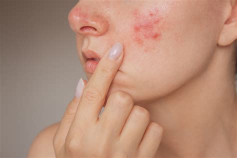 Eczema Vs Rosacea Know The Difference The Devonshire Clinic