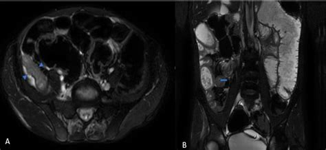 The String Sign In Crohns Disease Revista De Gastroenterología De México