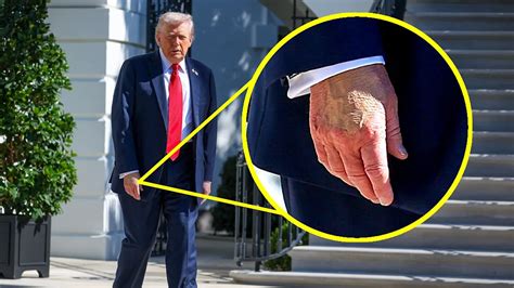 Trump 79 Coats Bruised Hand In Makeup After 4 Day Absence Yahoo