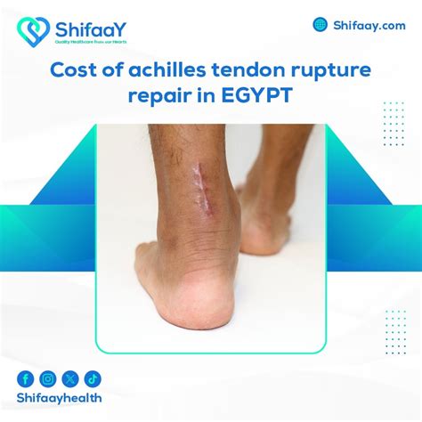 The Cost Of Achilles Tendon Rupture Surgery Shifaay