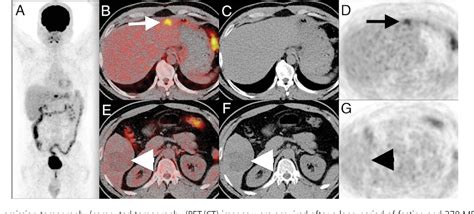 Figure 1 From Synchronous Hepatocellular Carcinoma And Cholangiocellular Carcinoma On 18f Fdg