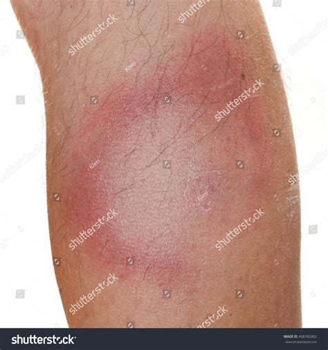 Best Erythema Royalty Free Images Stock Photos Pictures Shutterstock
