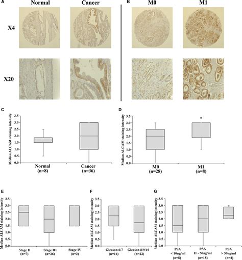 Alcam Tissue Expression In A Tissue Microarray Of Prostate And Prostate