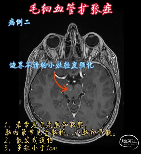 脑干毛细血管扩张症 脑医汇
