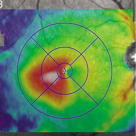 A OCT Volume Scan Of One Left Study Eye With Overlaid Retinal Download Scientific Diagram