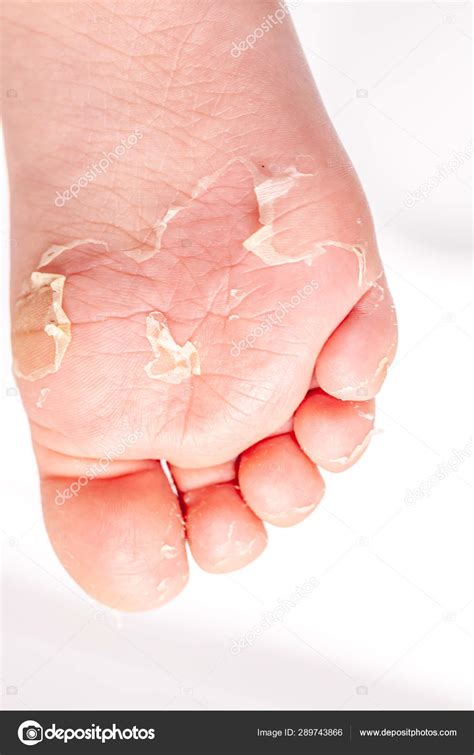 Scarlet Fever Rash Peeling