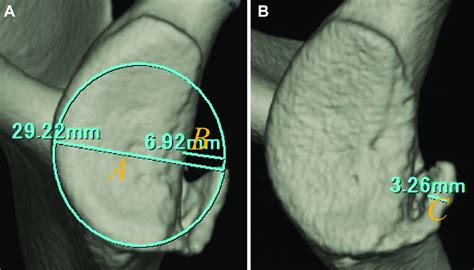 Quantification Method For The Glenoid Defect Size And Bone Fragment Download Scientific Diagram