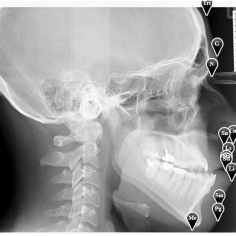 A Sample X Ray Image With Annotation Download Scientific Diagram