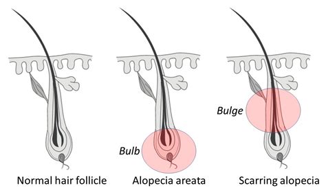 Hair Follicle Bulb