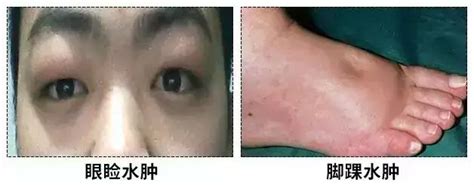 那一夜，“默默无闻”的肾病偷走我第一次眼泪肾脏