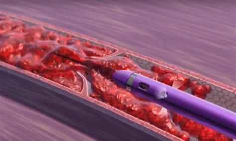 Angiojet Catheter Reference Guide At Eva Timmins Blog