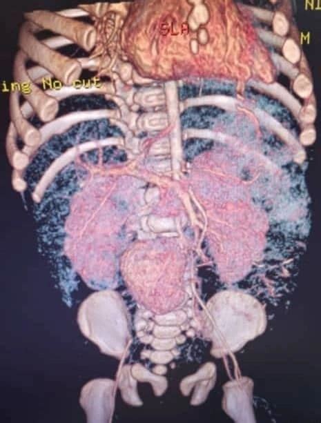 Aneurysm Iliac Infancy Javad Salimi