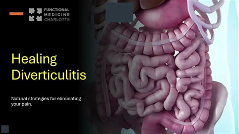 Diverticulitis How Do You Heal It Naturally Youtube