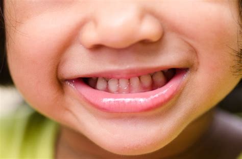 Как можно лечить кариес у детей