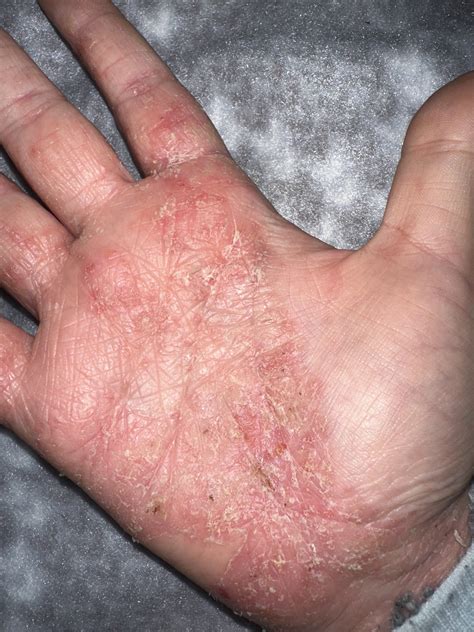 Advice For Products Rdyshidrosis