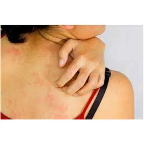 Metal Allergy In Homeopathy In Noida Id 25945722988