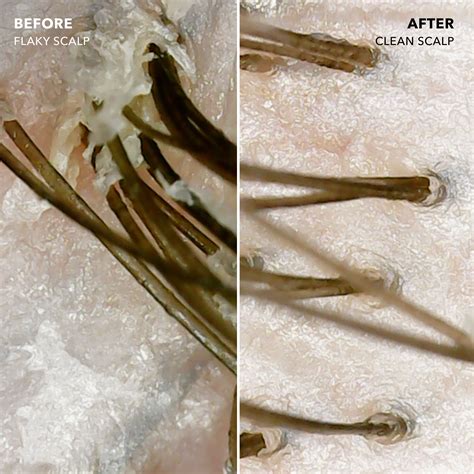 Itchy Flaky Scalp Artofit