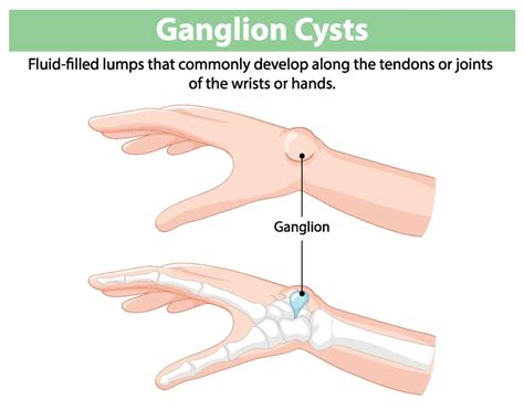 Effective Treatments For Ganglion Cysts From Home Remedies To Surgical