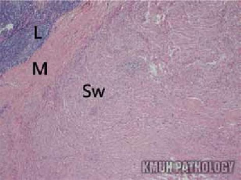 A Cuff Like Lymphoid Aggregate Was Recog Nized Peripheral To The Tumor Download Scientific