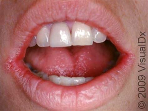 Angular Cheilitis Images Dermnet Nz