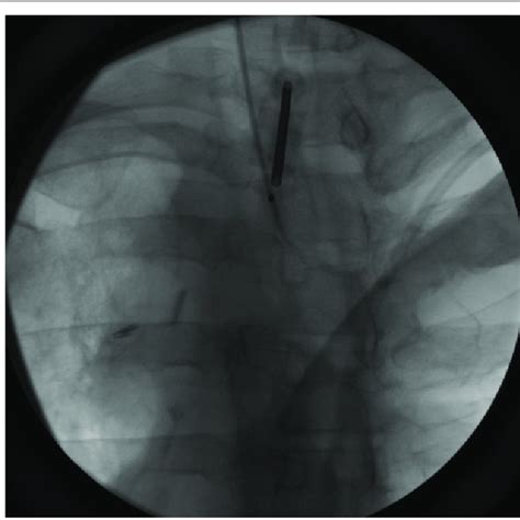 Anteroposterior View Of Fiducial Marker Placement Download Scientific Diagram