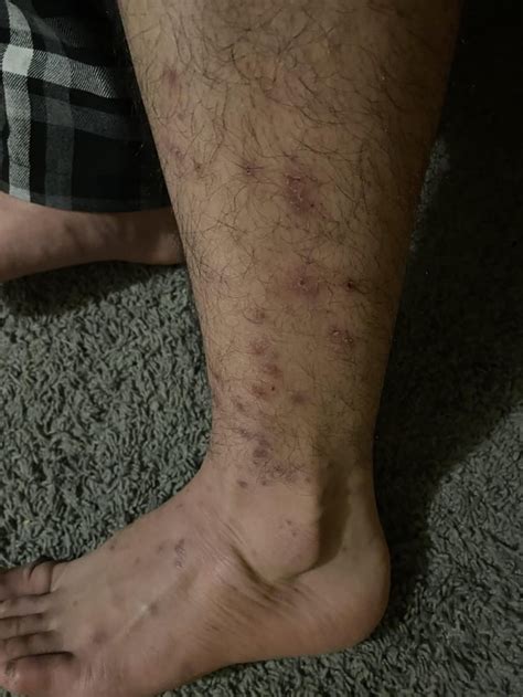 Red Itchy Spots On Lower Ankles And Top Of Foot Rmedical