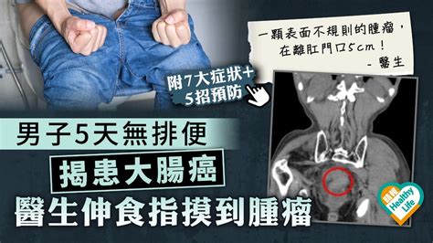 癌症殺手︳男子5天無排便揭患大腸癌 醫生伸食指摸到腫瘤：距肛門口5cm︳附7大症狀5招預防 晴報 健康 腫瘤及癌症 D230212