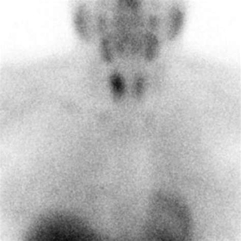 Parathyroid Imaging Canberra Act Southern Nsw