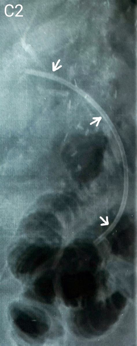 ERCP EGD Second Follow Up ERCP For Post Liver Transplant Anastomotic Stricture CASE A
