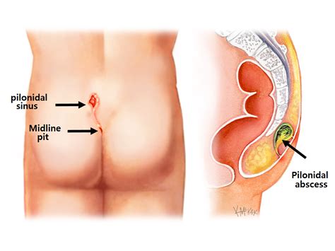 10 Datos Que Debes Saber Sobre La Enfermedad Pilonidal Innova Cirugía