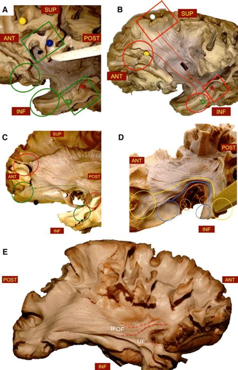 View Of The Fronto Temporal Opercular Region With The Exposed Uf Stem