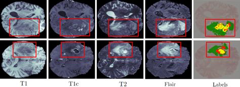Neuro Transunet Segmentation Of Stroke Lesion In Mri Using