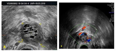 Secondary Amenorrhea And Infertility Due To An Inhibin B Producing