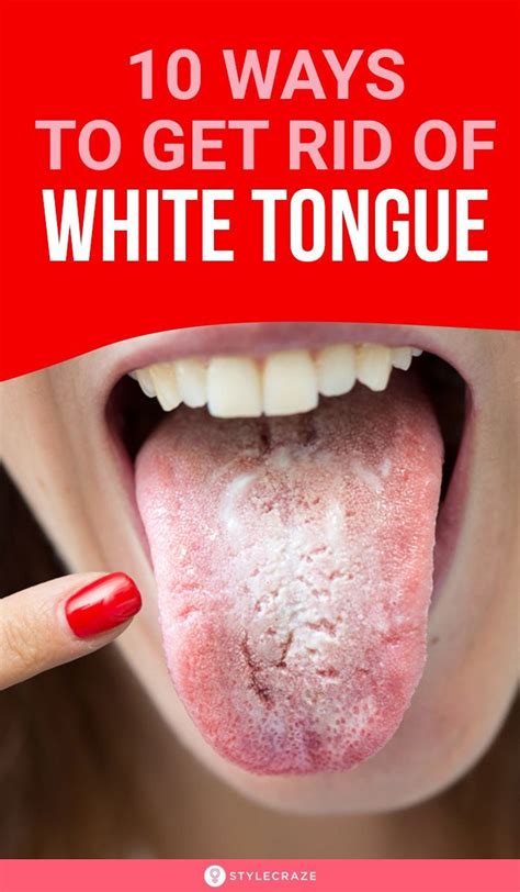 Why Is My Tongue White Tongue Periodontitis Dental